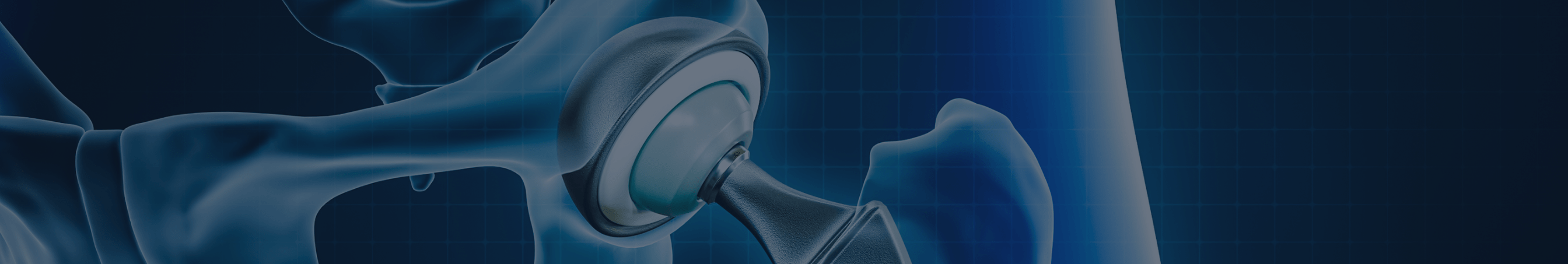 Outpatient Joint Replacement: Shoulder, Hip, and Knee - Peter Howard